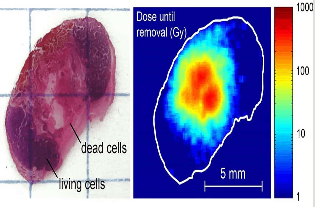 OurCrowd Portfolio Company Alpha Tau Medical Seeks New Cancer Treatment ...